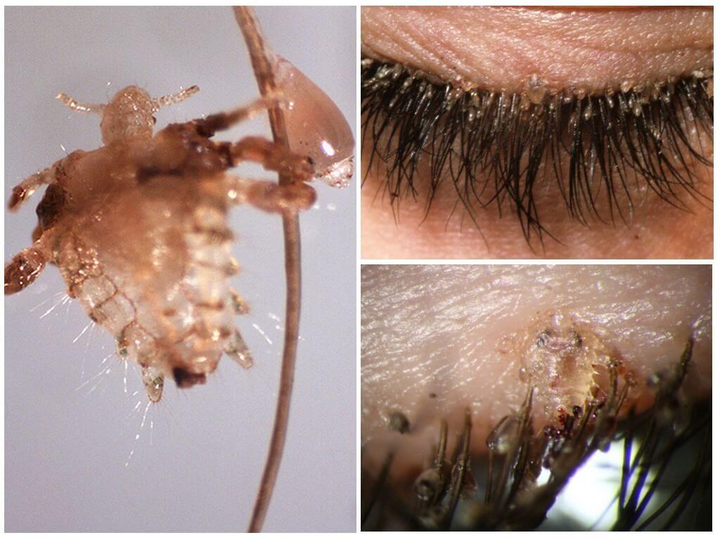 Воші на віях: фото і опис